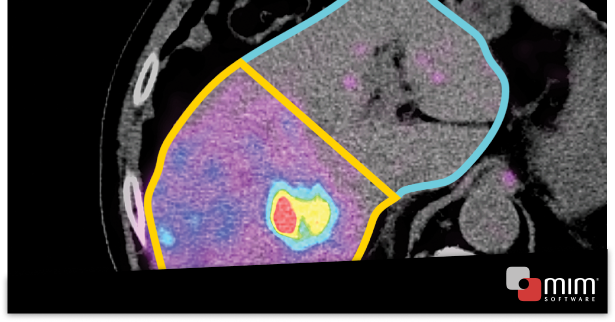 MIM Software | Y90 Therapy Support in Interventional Radiology